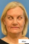 ULTRApulse Alpha: CO2 Laser machine for Skin Rejuvenation - Lumenis