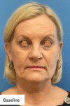 ULTRApulse Alpha: CO2 Laser machine for Skin Rejuvenation - Lumenis