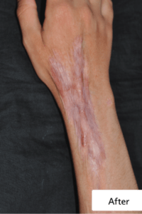ULTRApulse Alpha: CO2 Laser machine for Skin Rejuvenation - Lumenis