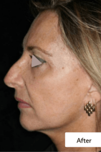 ULTRApulse Alpha: CO2 Laser machine for Skin Rejuvenation - Lumenis