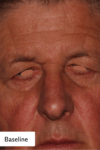 ULTRApulse Alpha: CO2 Laser machine for Skin Rejuvenation - Lumenis