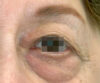 OptiLIFT: Lower Eyelid Laxity Treatment Machine - Lumenis