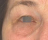 OptiLIFT: Lower Eyelid Laxity Treatment Machine - Lumenis