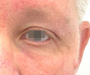 OptiLIFT: Lower Eyelid Laxity Treatment Machine - Lumenis