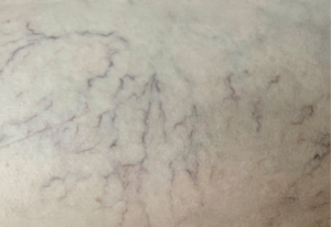 SPLENDOR X: Professional Laser Hair Removal Machine